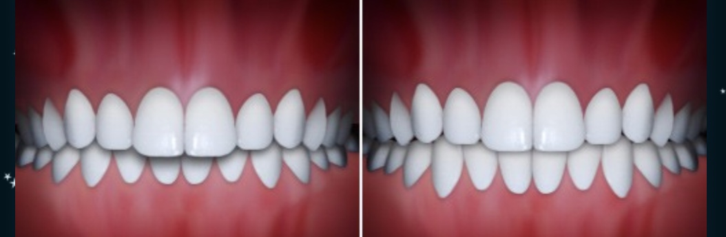 Before & After | Dr. Ng Orthodontics